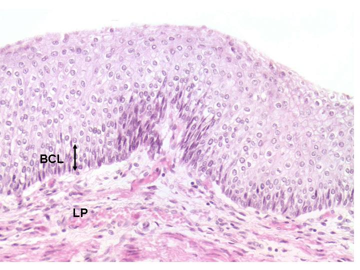 Endoscopy Pictures Of Normal Esophagus at Lisa Wiggins blog