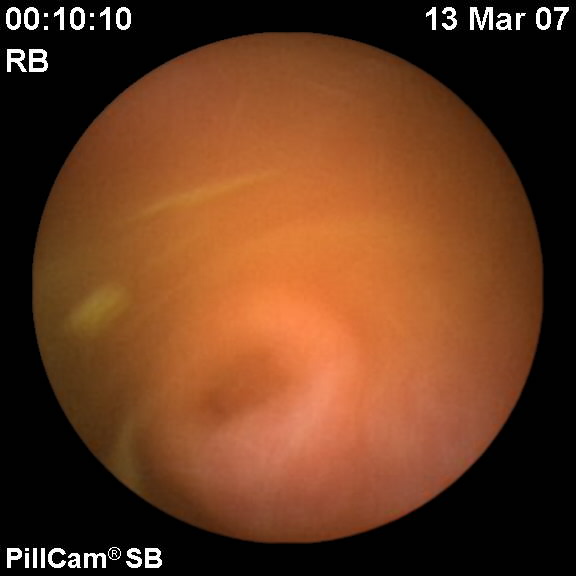 Stomach GI Photo Gallery